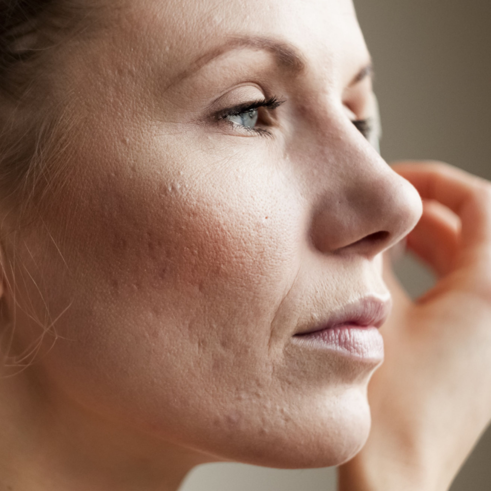 Acne Scar Treatments in Kansas City | Aestheticare Medspa AesthetiCare