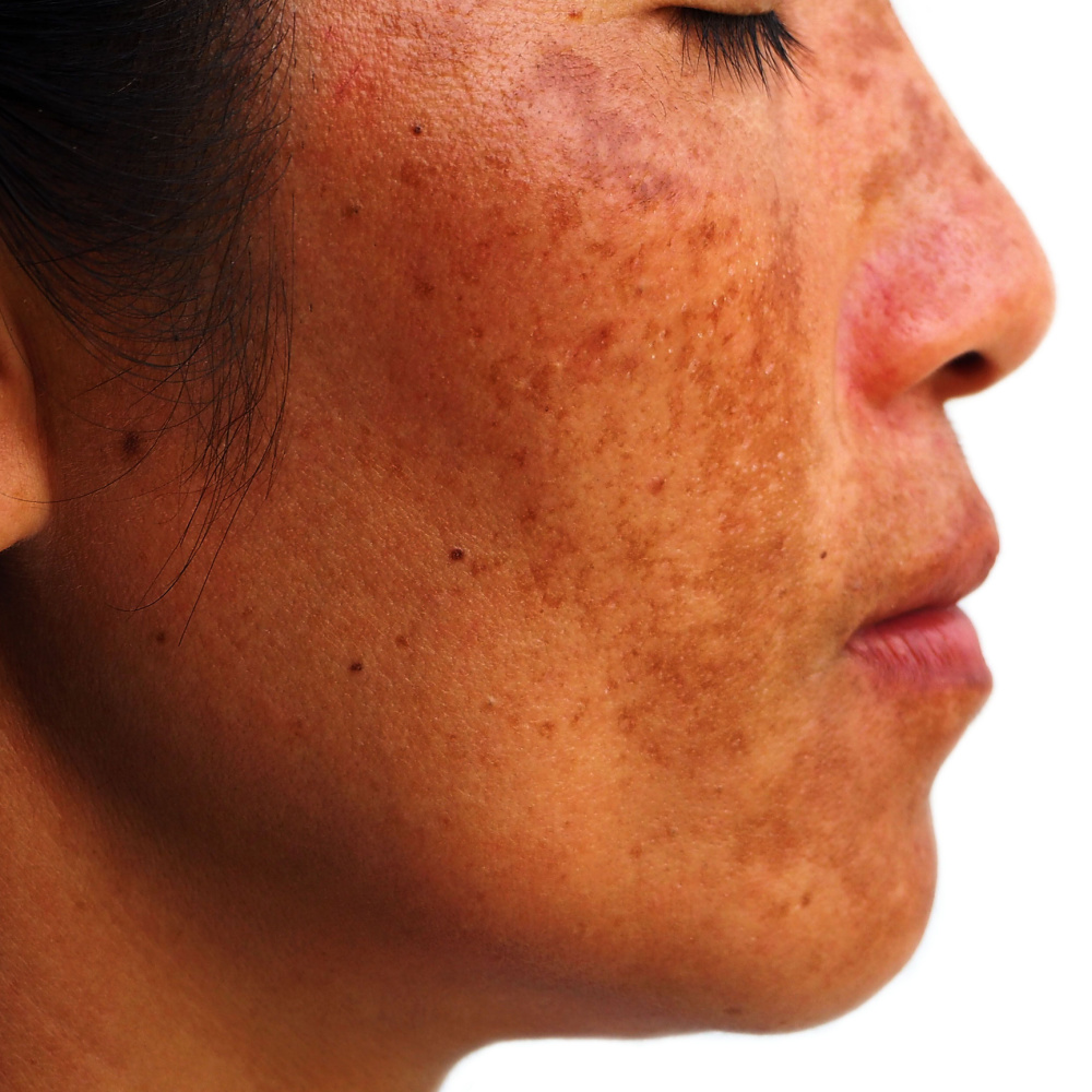Melasma Treatments in Kansas City | Aestheticare Medspa AesthetiCare