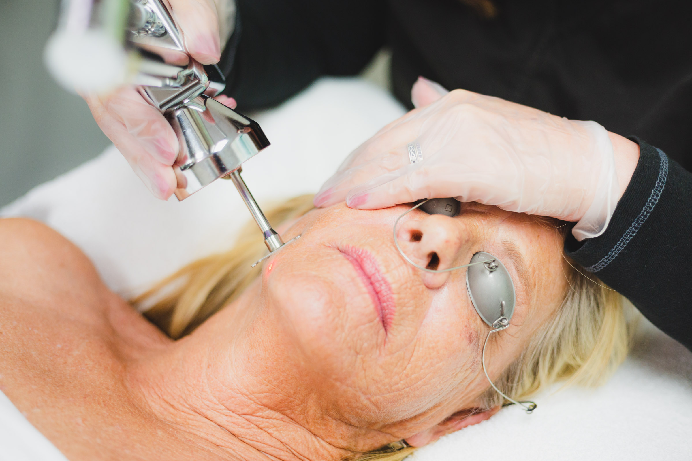 ProFractional Laser in Kansas City | Aestheticare Medspa AesthetiCare