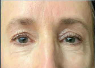 Age Jet - AesthetiCare AesthetiCare