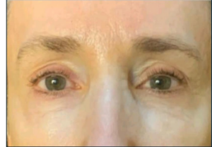 Age Jet - AesthetiCare AesthetiCare