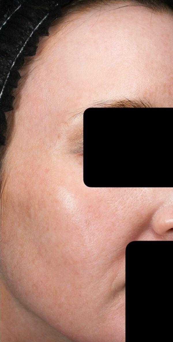 Age Jet - AesthetiCare AesthetiCare